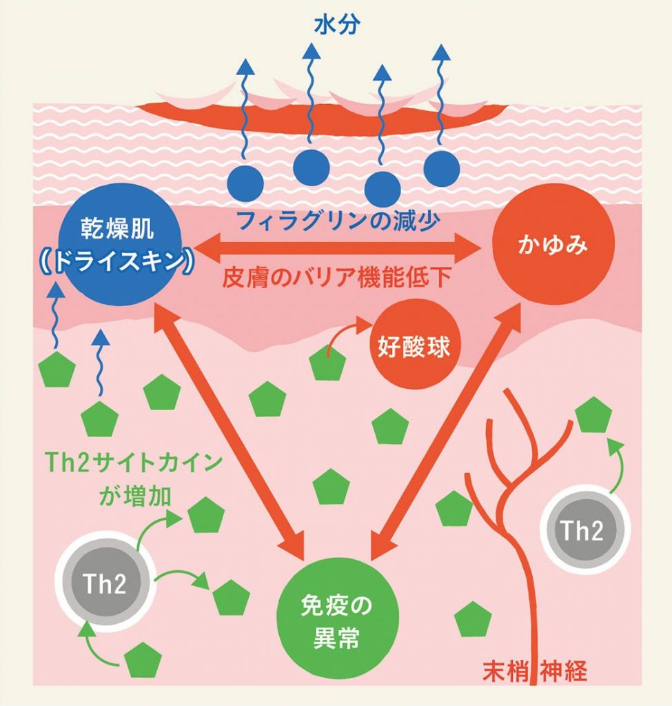 ステロイドの正しい使い方、新薬、最新治療…。大人アトピーの正しい知識